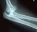 Reduction of Radial Head Dislocation: Background, Indications ...