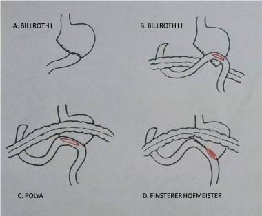 Partial Gastrectomy Procedure