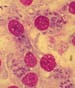 Toxoplasmosis Workup: Approach Considerations, Immunoglobulin Testing ...