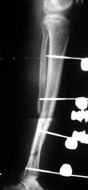 Tibial Nonunions Treatment & Management: Approach Considerations ...