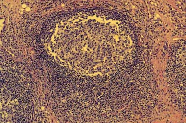 Cutaneous Pseudolymphoma: Background, Pathophysiology, Etiology