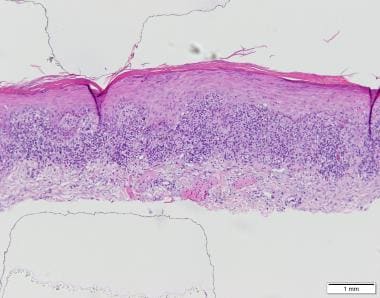 Erosive Lichen Planus Histology