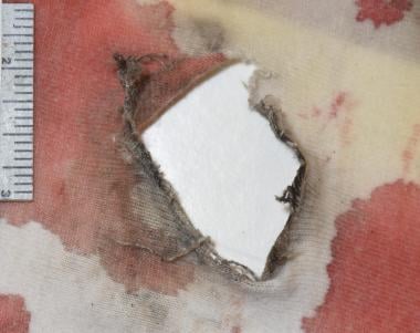 Forensic Pathology of Firearm Wounds: Overview, Modern Ammunition ...