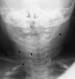 Infantile Cortical Hyperostosis (Caffey Disease): Practice Essentials ...