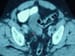Enterovesical Fistula: Practice Essentials, History of the Procedure ...