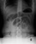 Laparoscopic Adhesiolysis: Background, Indications, Contraindications