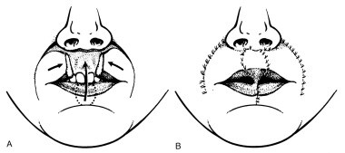 Lip Reconstruction Procedures Treatment & Management: Medical Therapy ...