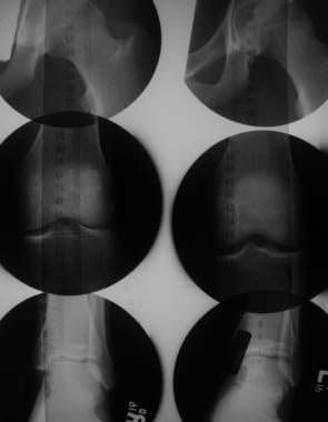 Growth Plate Fractures (Physeal Fractures) Clinical Presentation ...