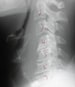Spinal Infections Guidelines: IDSA Guidelines for Native Vertebral ...
