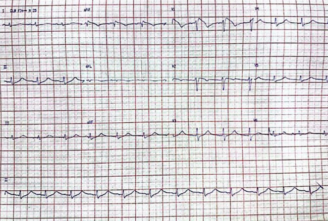 Homem em tratamento para tonsilite é levado ao PS com síncope