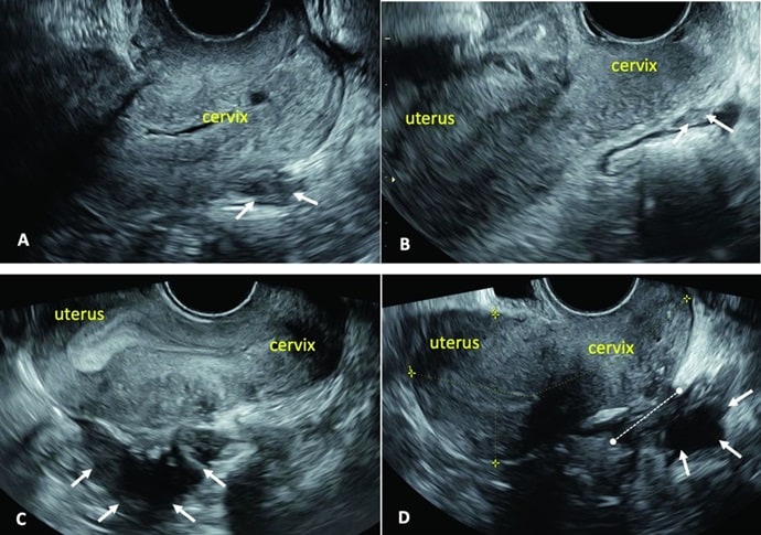 Uso da ultrassonografia no diagnóstico e tratamento da endometriose
