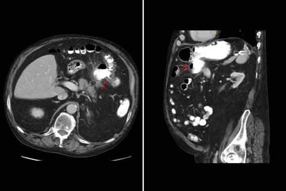 Desafio Diagnóstico: Dor abdominal crônica após colonoscopia