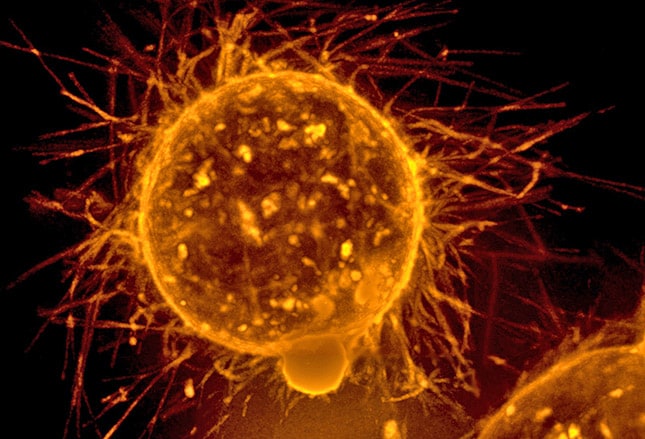 Câncer bem de perto: veja 20 imagens microscópicas arrebatadoras de ...