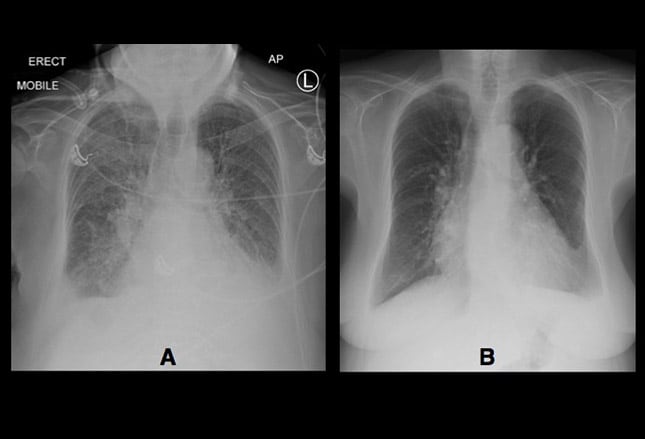 Revisão de radiologia do tórax na emergência