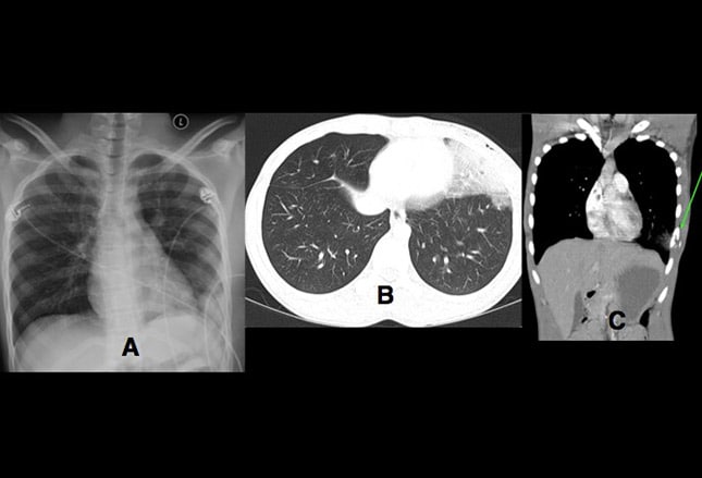 Revisão de radiologia do tórax na emergência
