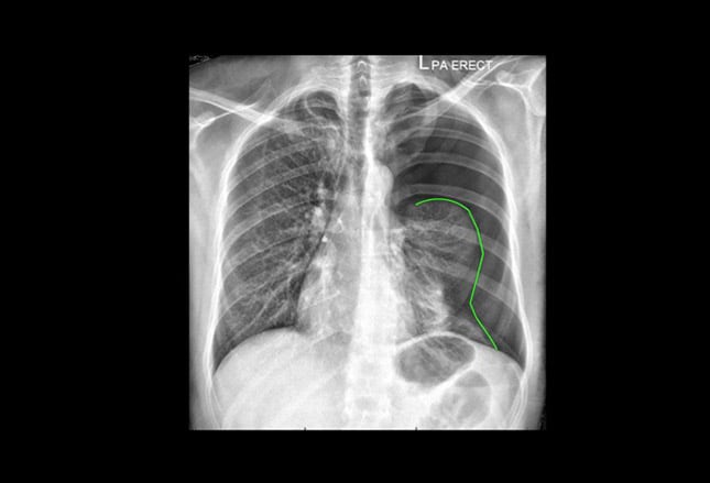 Revisão de radiologia do tórax na emergência