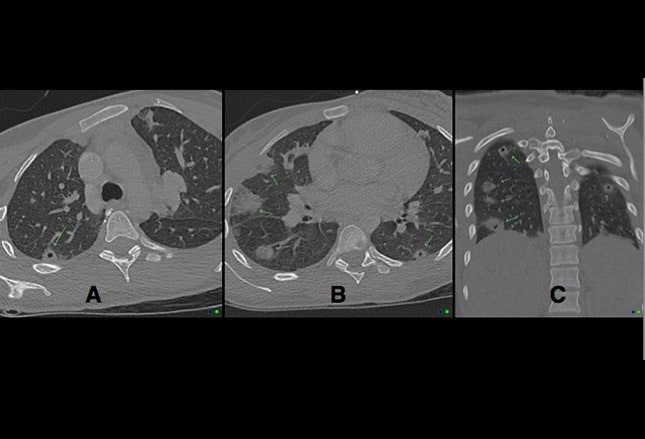 Revisão de radiologia do tórax na emergência