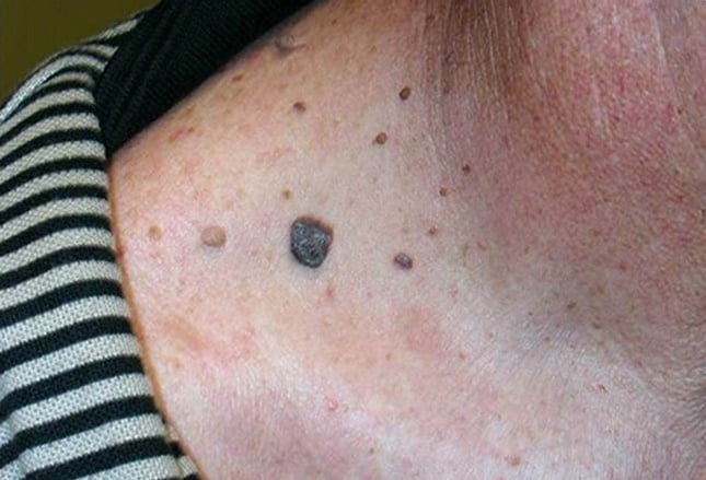 Pinta ou melanoma? Teste seus conhecimentos com essas lesões suspeitas