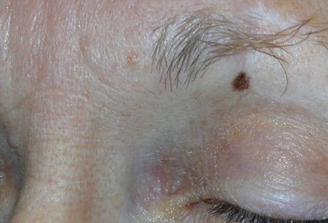 Pinta ou melanoma? Teste seus conhecimentos com essas lesões suspeitas