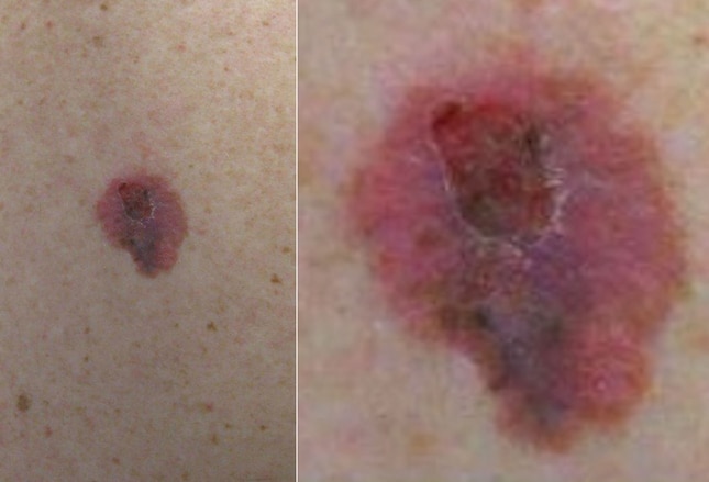 Pinta ou melanoma? Teste seus conhecimentos com essas lesões suspeitas