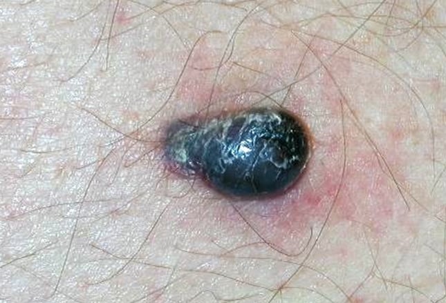 Pinta ou melanoma? Teste seus conhecimentos com essas lesões suspeitas