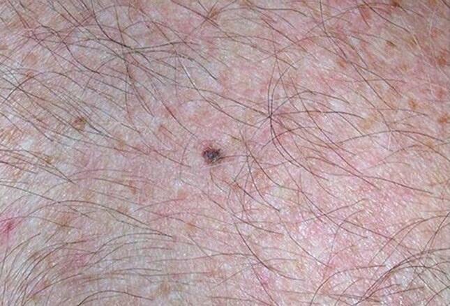 Pinta ou melanoma? Teste seus conhecimentos com essas lesões suspeitas