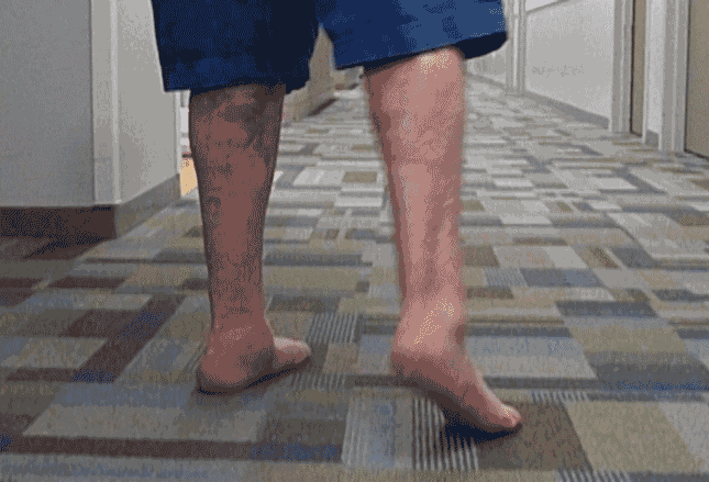 Alterações da marcha: quando o paciente não consegue andar em linha reta