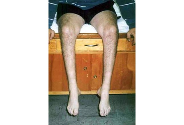 Alterações da marcha: quando o paciente não consegue andar em linha reta