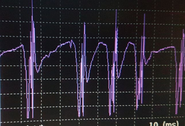 Alterações da marcha: quando o paciente não consegue andar em linha reta
