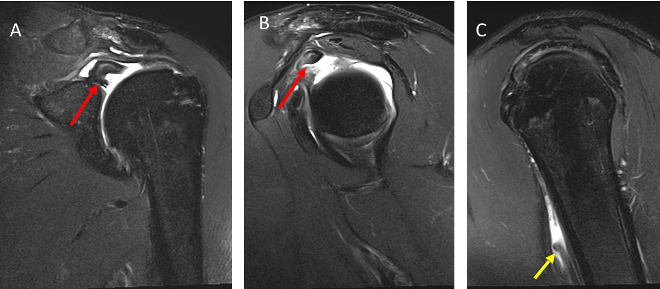 Avaliação das principais causas de dor no ombro por meio de ressonância ...