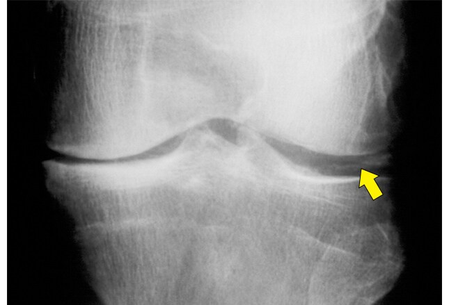 Revisando os aspectos da gota