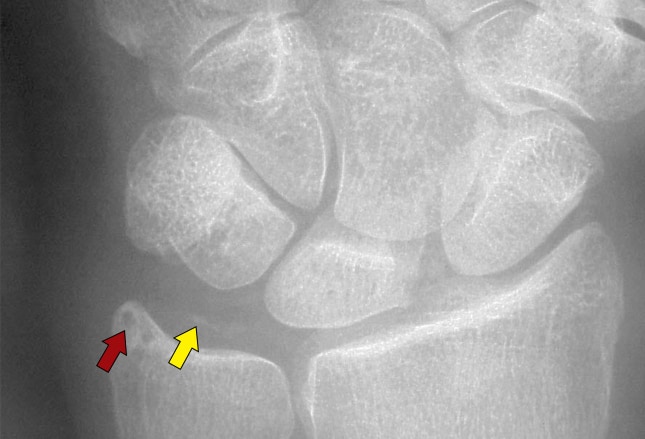 Revisando os aspectos da gota