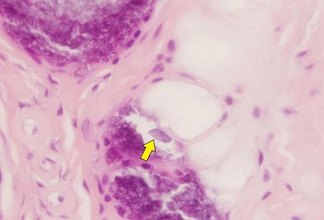 Revisando os aspectos da gota