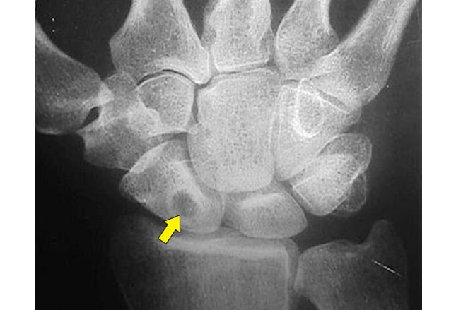 Revisando os aspectos da gota