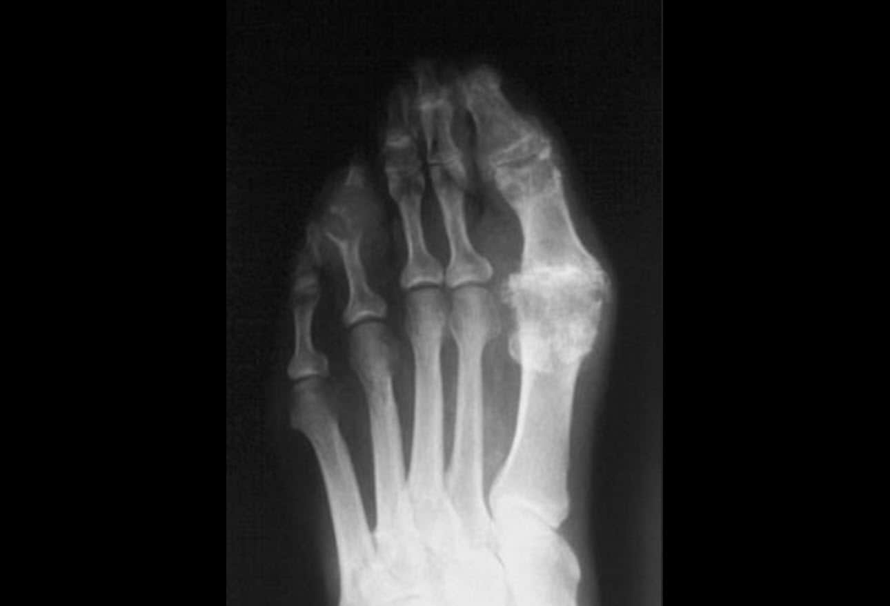 Revisando os aspectos da gota