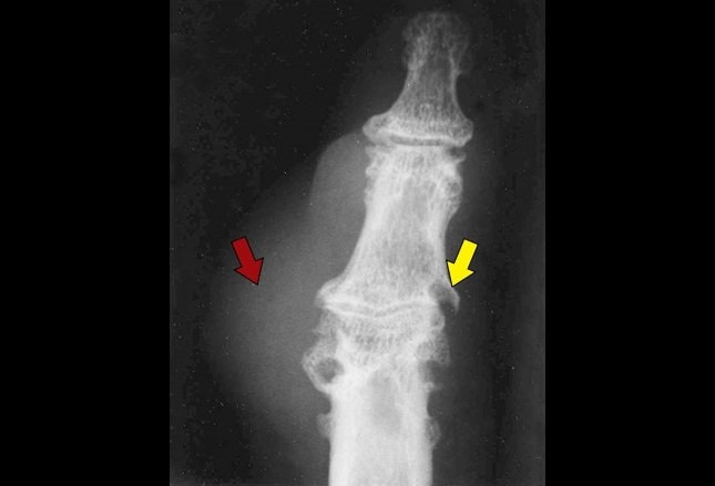 Revisando os aspectos da gota