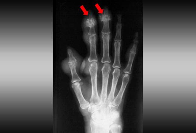 Revisando os aspectos da gota