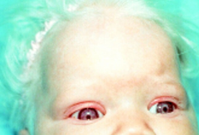 11 doenças de pele em recém-nascidos