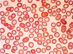 Teste: O que você sabe sobre a anemia ferropriva? - Page 5