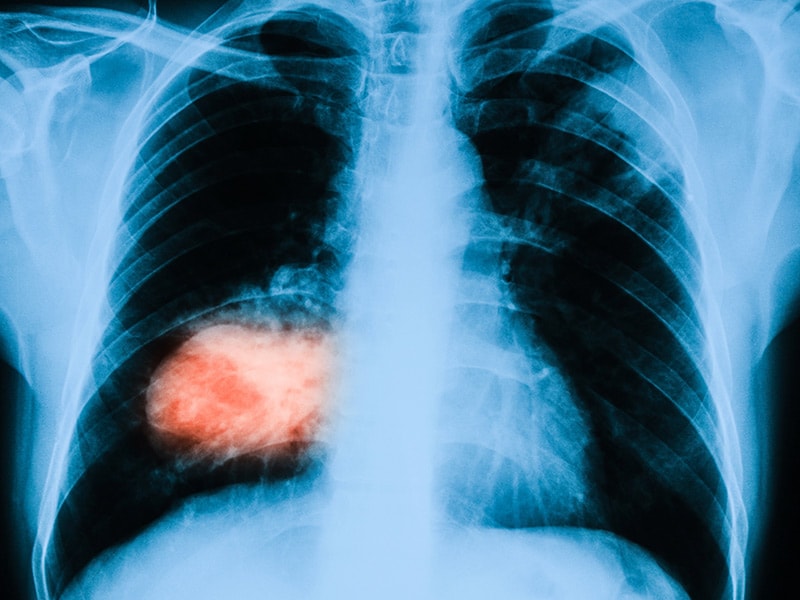 Keynote-042: Fim da linha para a quimioterapia em câncer de pulmão não ...