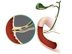 Teste seu conhecimento sobre cálculos biliares