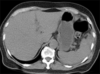 Paciente com dor abdominal no flanco esquerdo, irradiada para a fossa ...