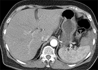 Paciente com dor abdominal no flanco esquerdo, irradiada para a fossa ...