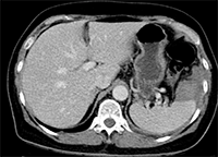 Paciente com dor abdominal no flanco esquerdo, irradiada para a fossa ...