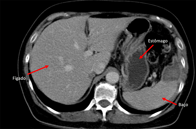 Paciente com dor abdominal no flanco esquerdo, irradiada para a fossa ...
