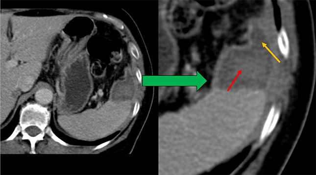Paciente com dor abdominal no flanco esquerdo, irradiada para a fossa ...