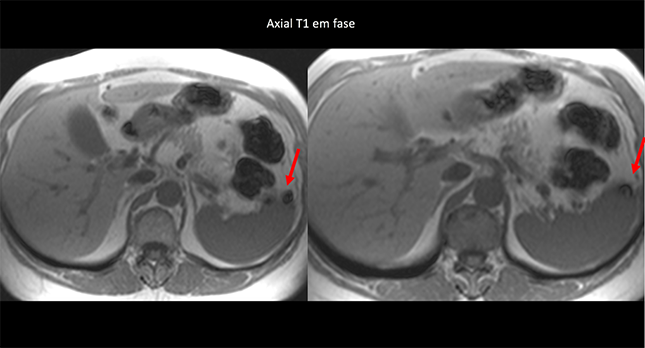 Paciente com dor abdominal no flanco esquerdo, irradiada para a fossa ...