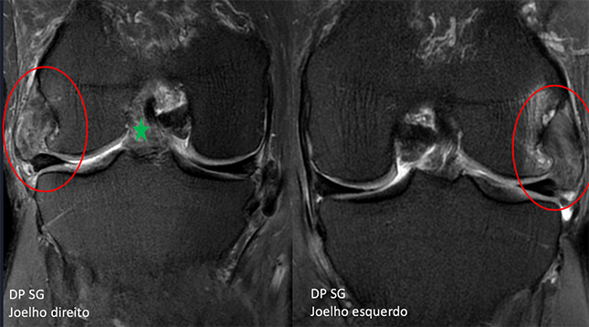 Articulacao Interfalangica Distal