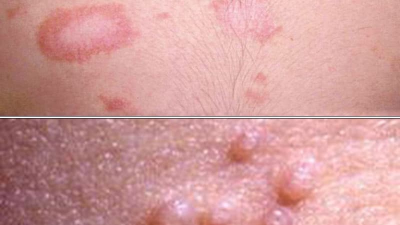 Você sabe reconhecer e diferenciar os exantemas mais comuns? - Page 5