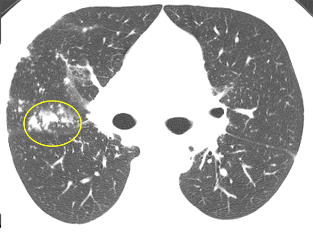 Paciente de 40 anos com tosse e dispneia associada a discreta perda ...